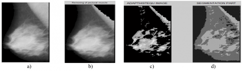 Comparative Analysis of Texture Patterns on Mammograms for Classification | IIETA