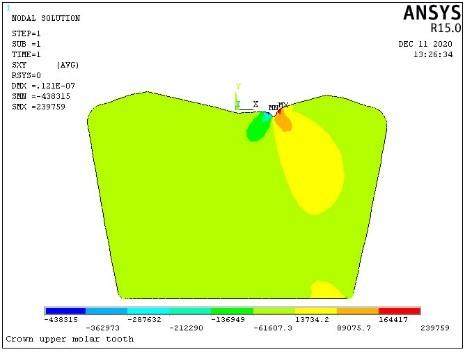 State Stress Analysis of Dental Restoration Materials Using the ANSYS ...