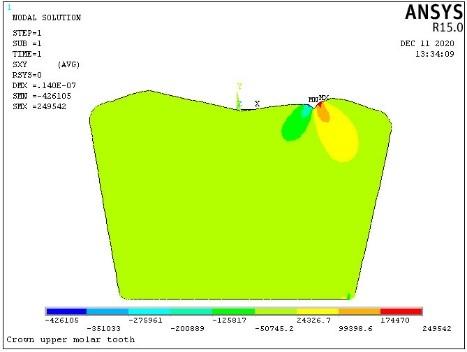 State Stress Analysis of Dental Restoration Materials Using the ANSYS ...