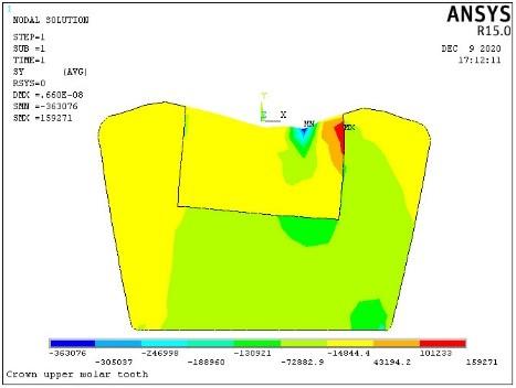 State Stress Analysis of Dental Restoration Materials Using the ANSYS ...