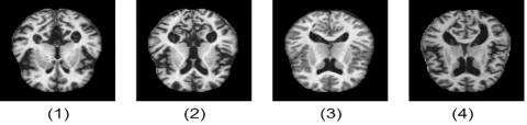 Enhanced Classification of Alzheimer’s Disease Stages via Weighted ...