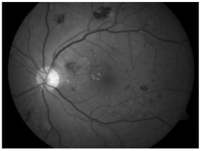 Enhanced Detection of Diabetic Retinopathy Using Ensemble Machine ...