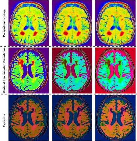 Hierarchical Spatial Feature-CNN Employing Grad-CAM for Enhanced ...